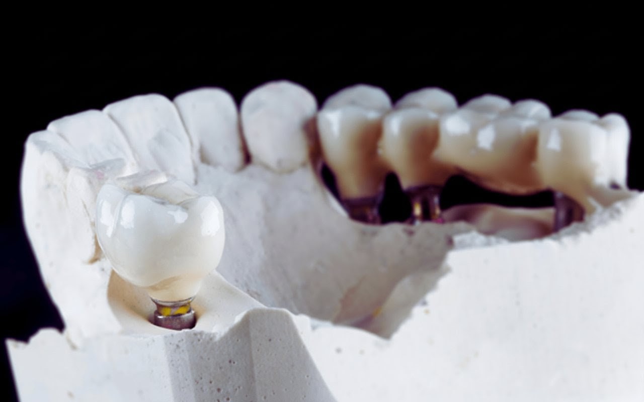 Types of Dental Bridges